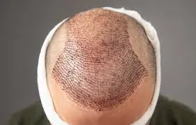 Exploring the Connection Between Hair Transplant and Trypophobia: A ...