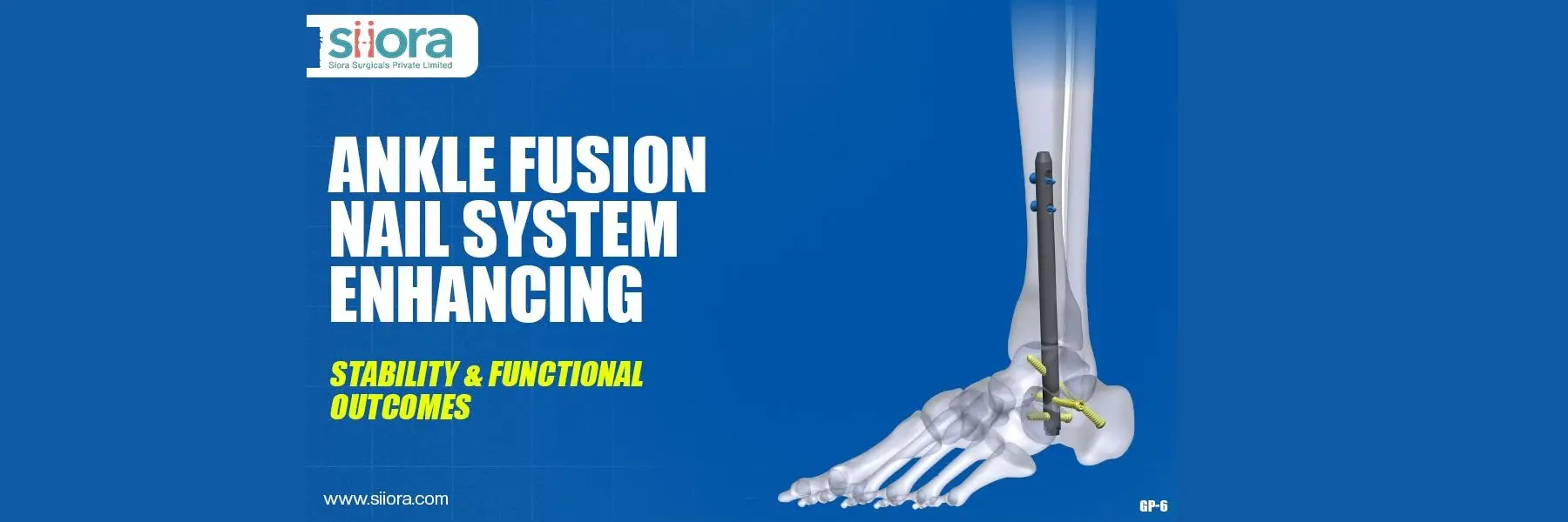 Ankle Fusion Nail System: Enhancing Stability & Functional Outcomes ...